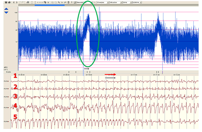 aEEG脳波トレンド『aEEGてんかん発作パターン：10分間のてんかん発作中のaEEG/EEGのevolution』アイ・エム・アイ（株）